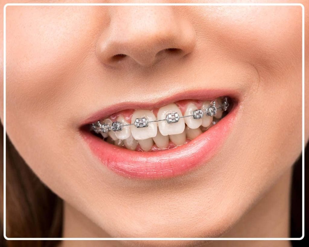 Metal Keramika Qapaqlar Nədir? | Metal Keramika Dişlərin Hazırlanması